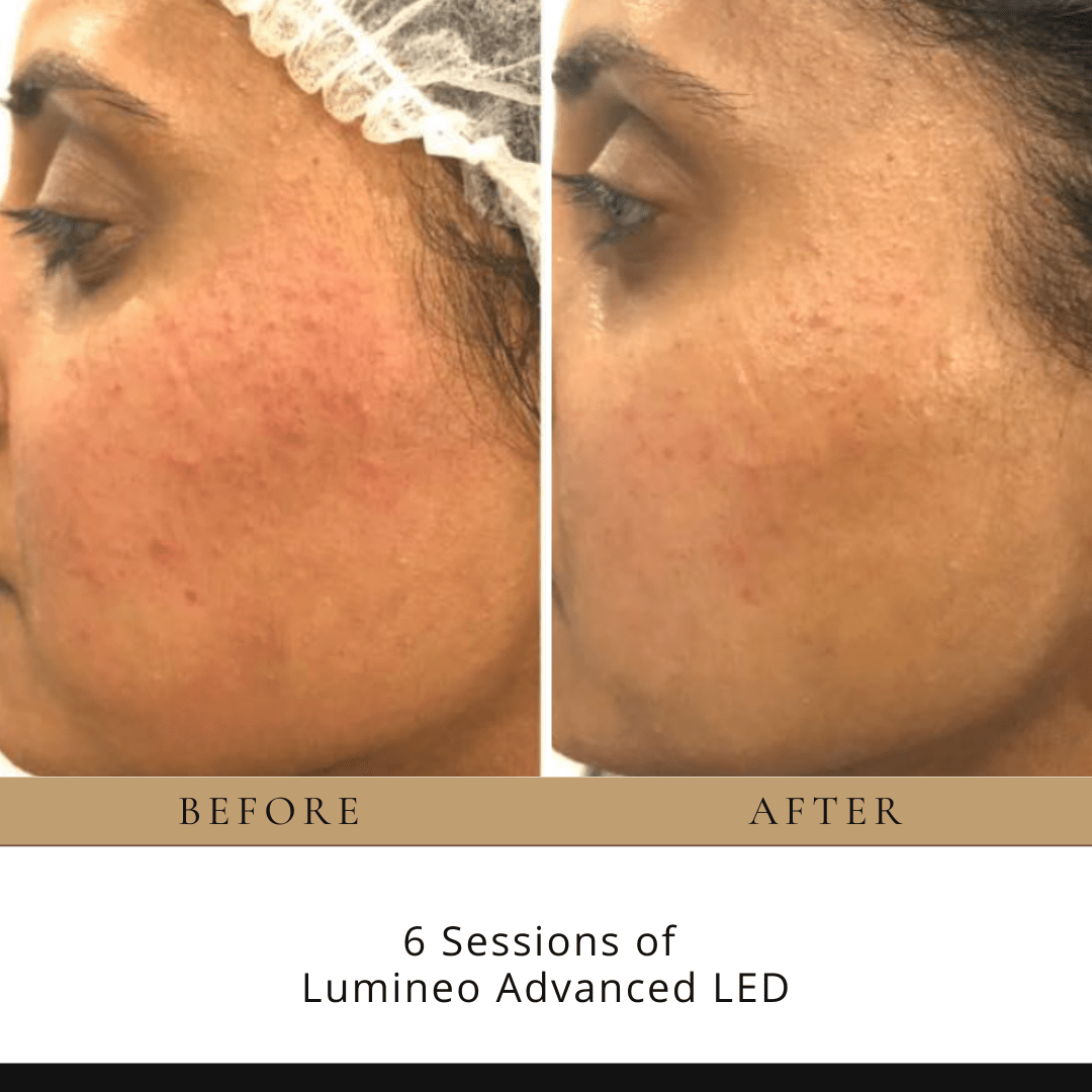 Best Professional LED Light Therapy Machine UK | Lumineo by Neo ...